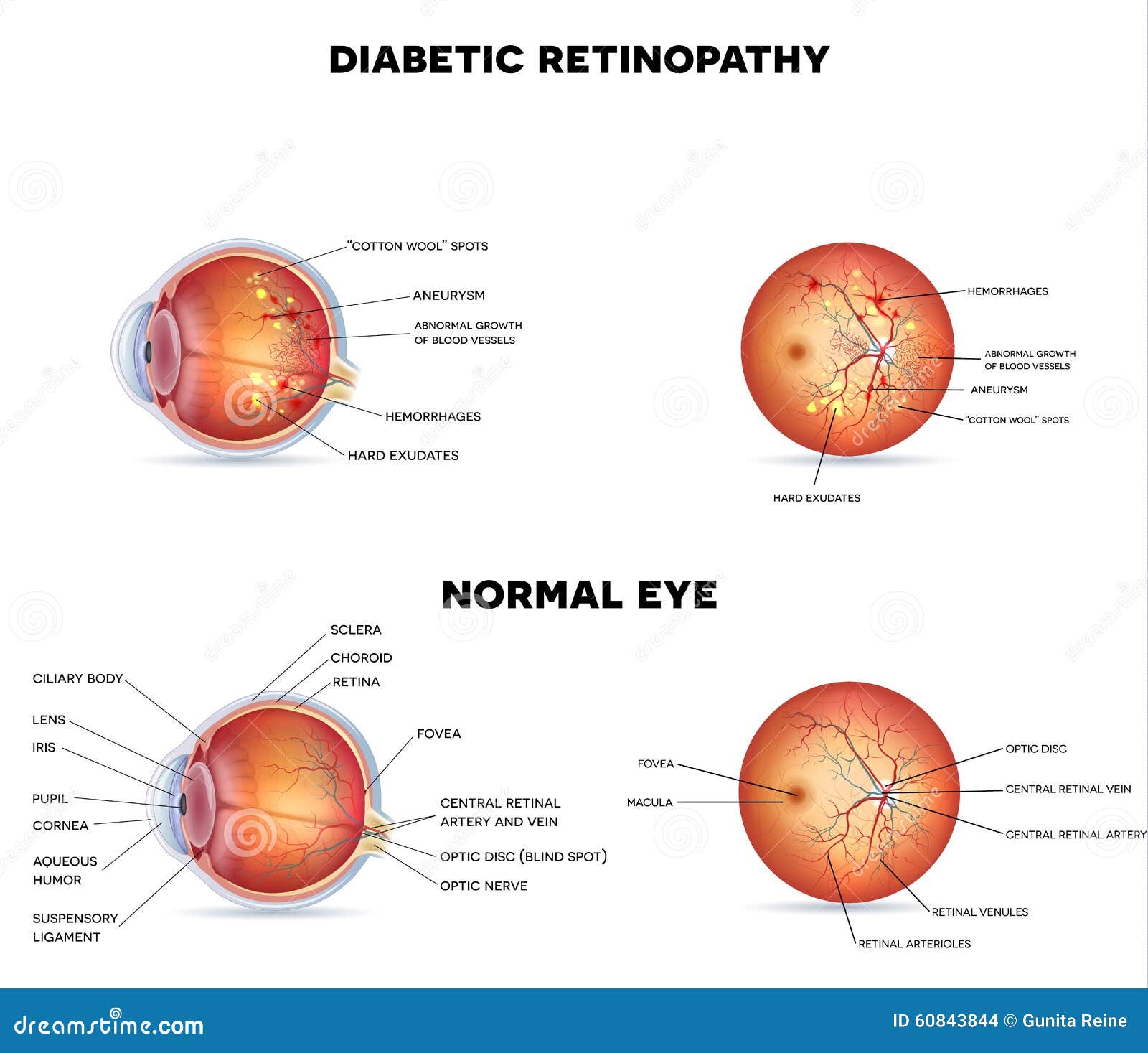 Diabetic Retinopathy Vector Illustration Diagram, Anatomical Scheme ... Diabetic Retinopathy Vector Illustration Diagram, Anatomical Scheme ...