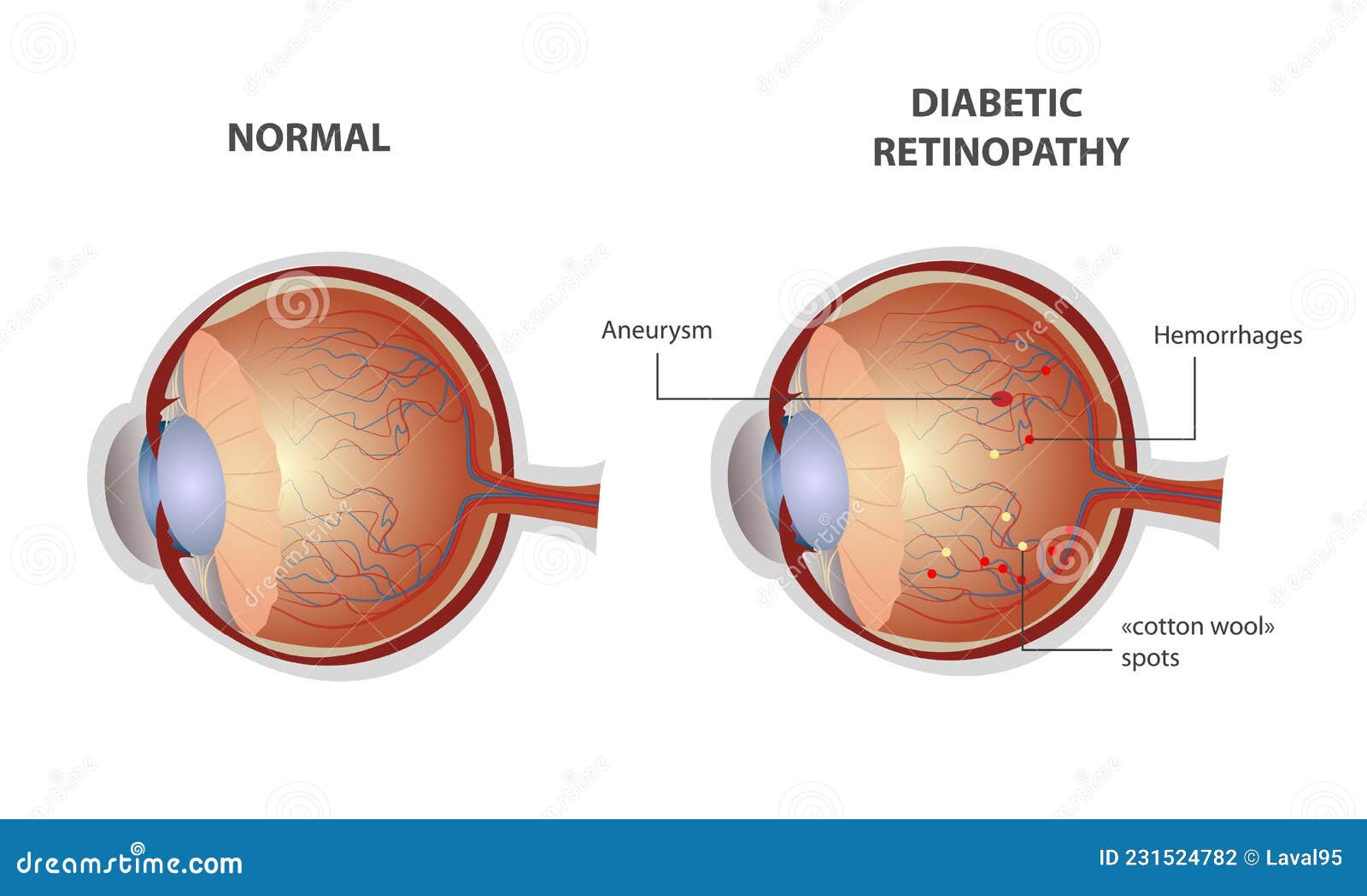 Diabetic Retinopathy, Eye, Vector Medical Illustration with Symbols ... Diabetic Retinopathy, Eye, Vector Medical Illustration with Symbols ...