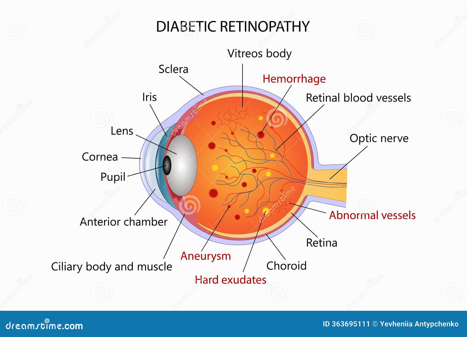 Diabetic Retinopathy, Ophthalmoscopic Diagnosis, Illustration ...