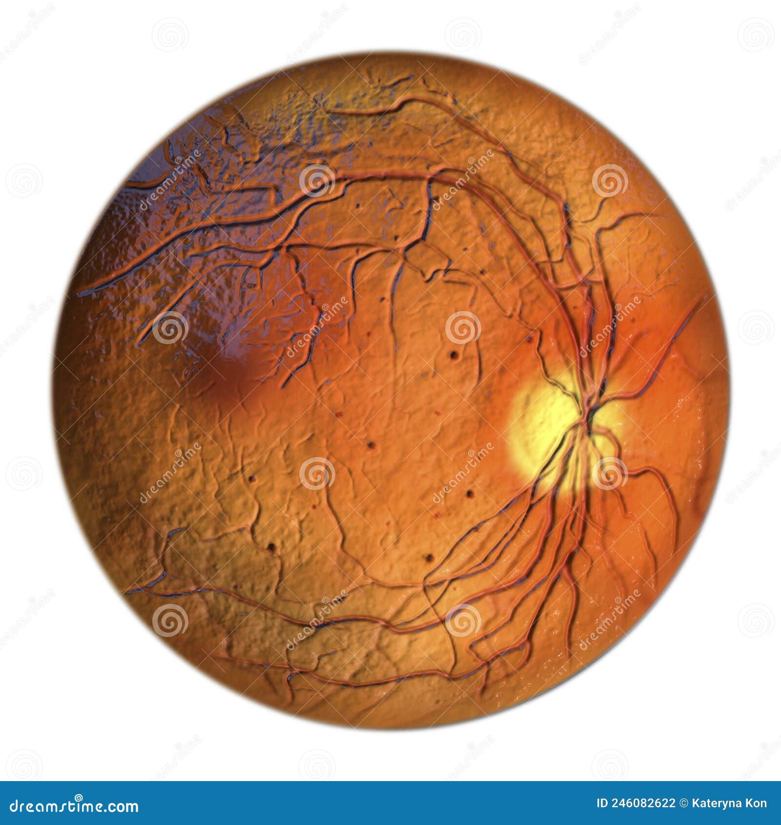 Diabetic Retinopathy Vector Illustration Diagram, Anatomical Scheme ... Diabetic Retinopathy Vector Illustration Diagram, Anatomical Scheme ...