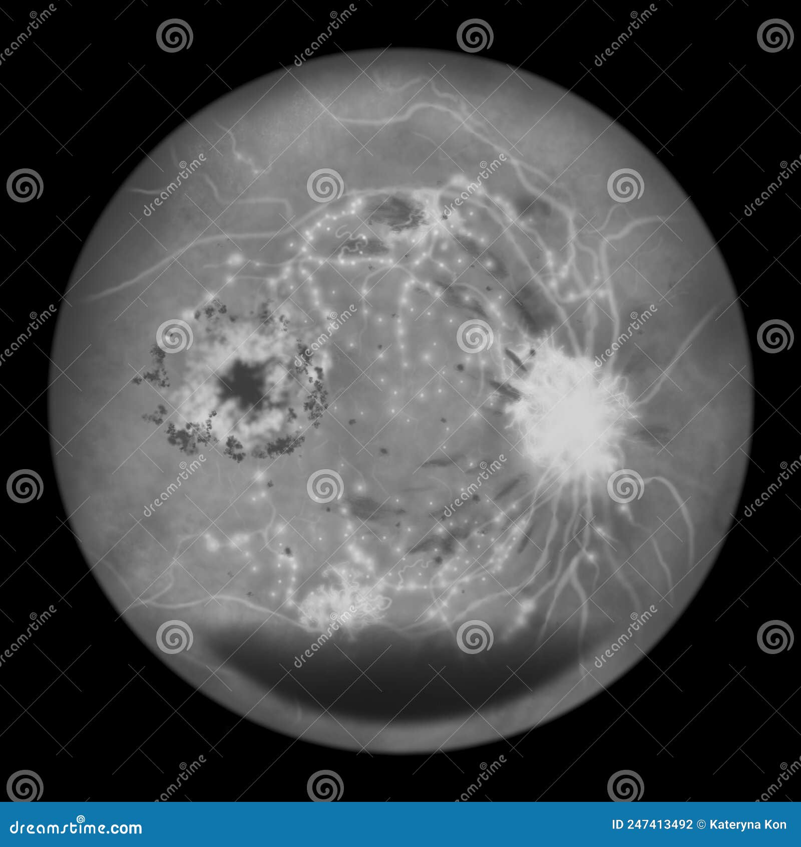 Diabetic Retinopathy Vector Illustration Diagram, Anatomical Scheme ... Diabetic Retinopathy Vector Illustration Diagram, Anatomical Scheme ...