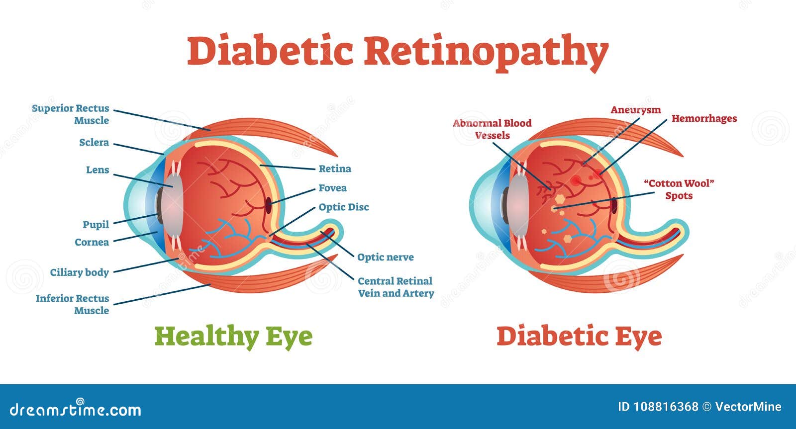 Diabetic Retinopathy Vector Illustration Diagram, Anatomical Scheme ... Diabetic Retinopathy Vector Illustration Diagram, Anatomical Scheme ...