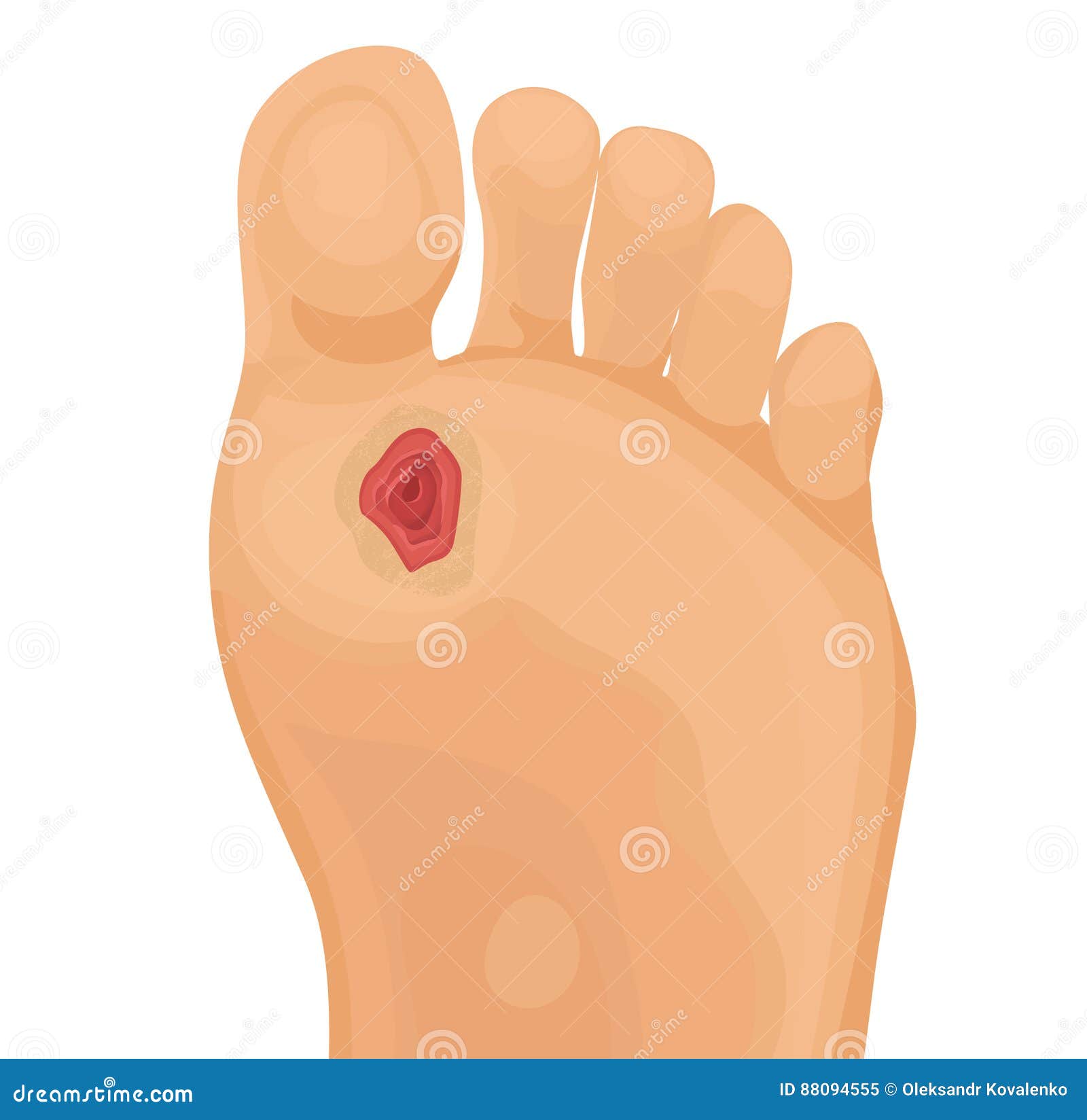 Diabetic Ulcer, Cracked Heel, Fungus Infection, Stinky Foot Cartoon ...