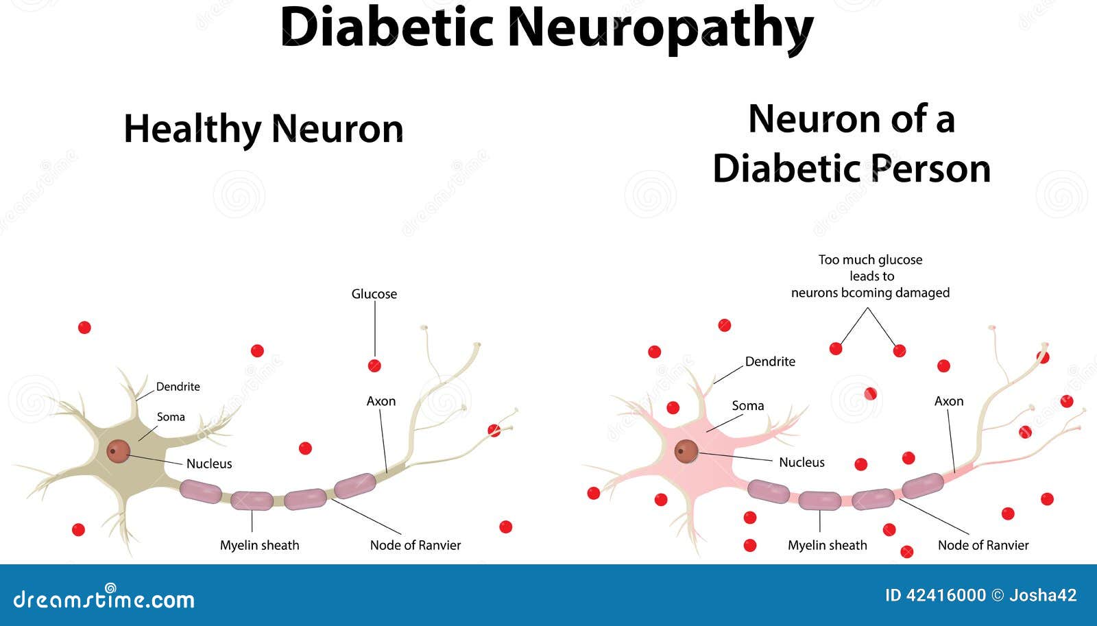 Diabetisk Neuropathy vektor illustrationer. Illustration av diabetiker ...