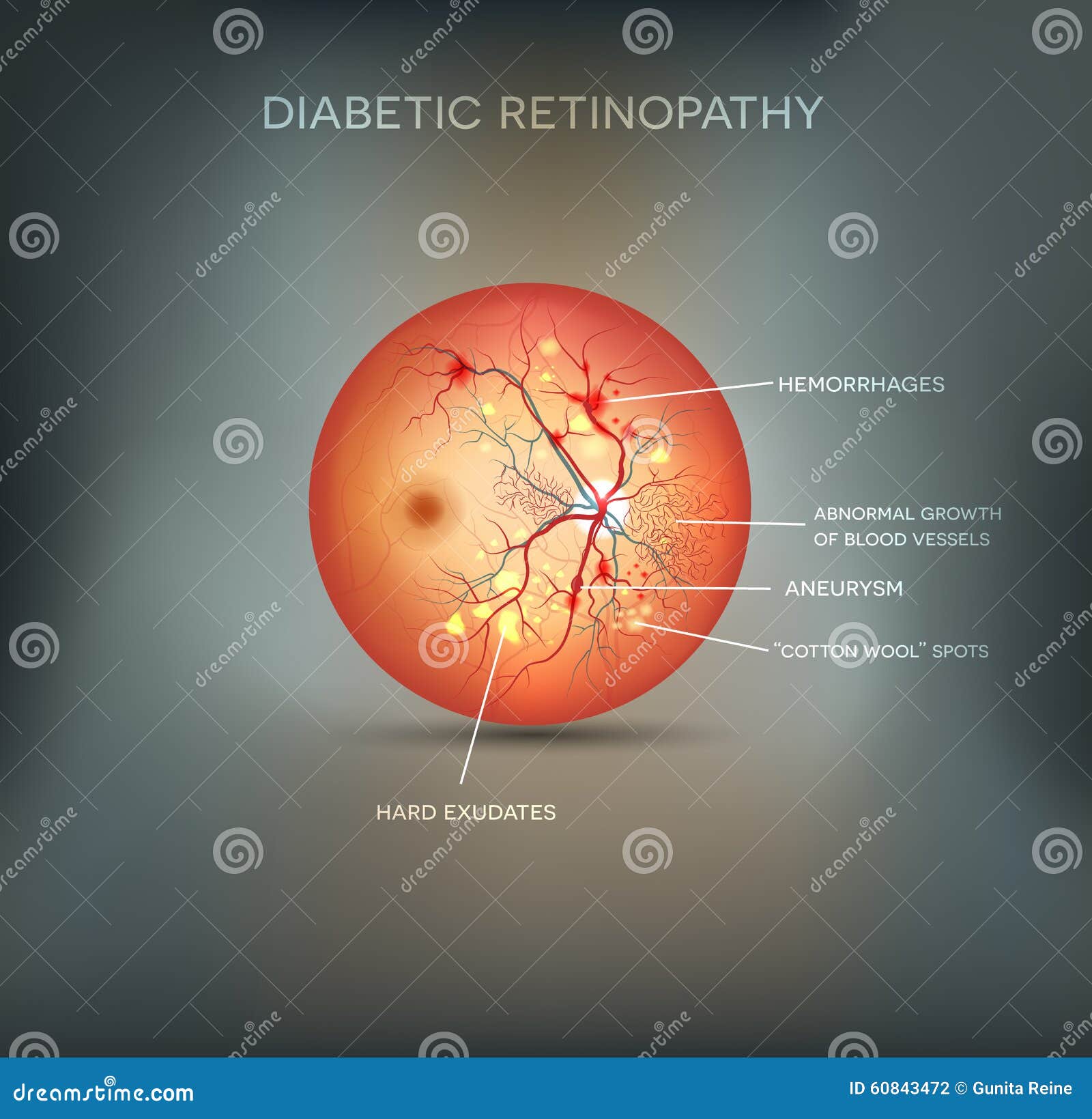 Diabetisk Retinopathybakgrund Vektor Illustrationer - Illustration av ...