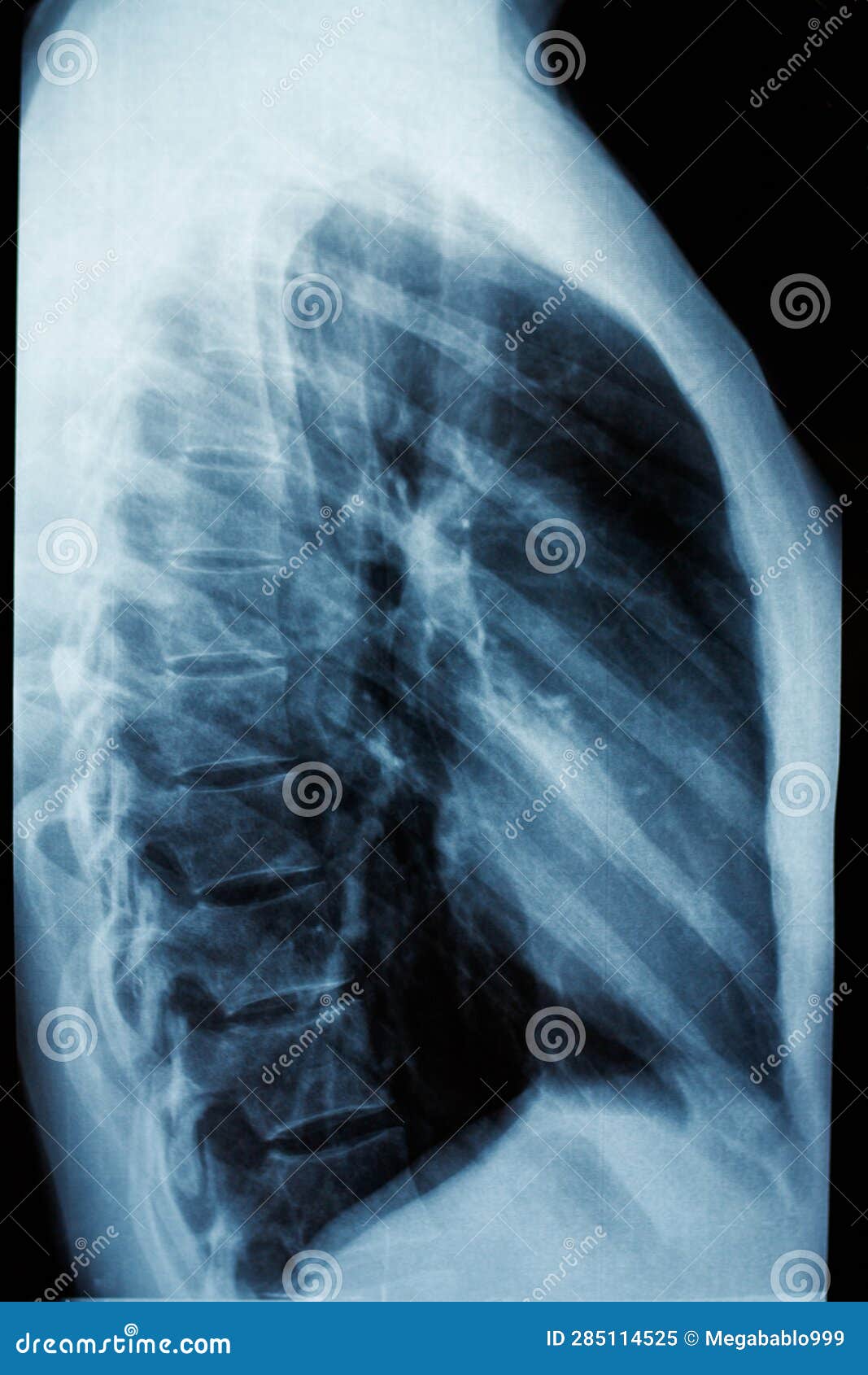 Diagnosis with X-ray. Fluorography of the Human Chest, Side View Stock ...