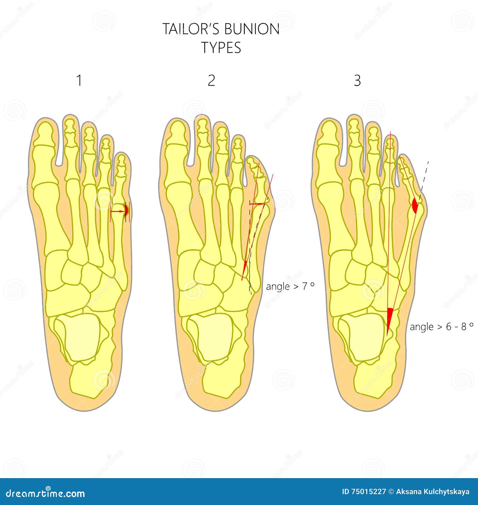 Diagnosis of the Tailor S Bunion Stock Vector - Illustration of disease ...