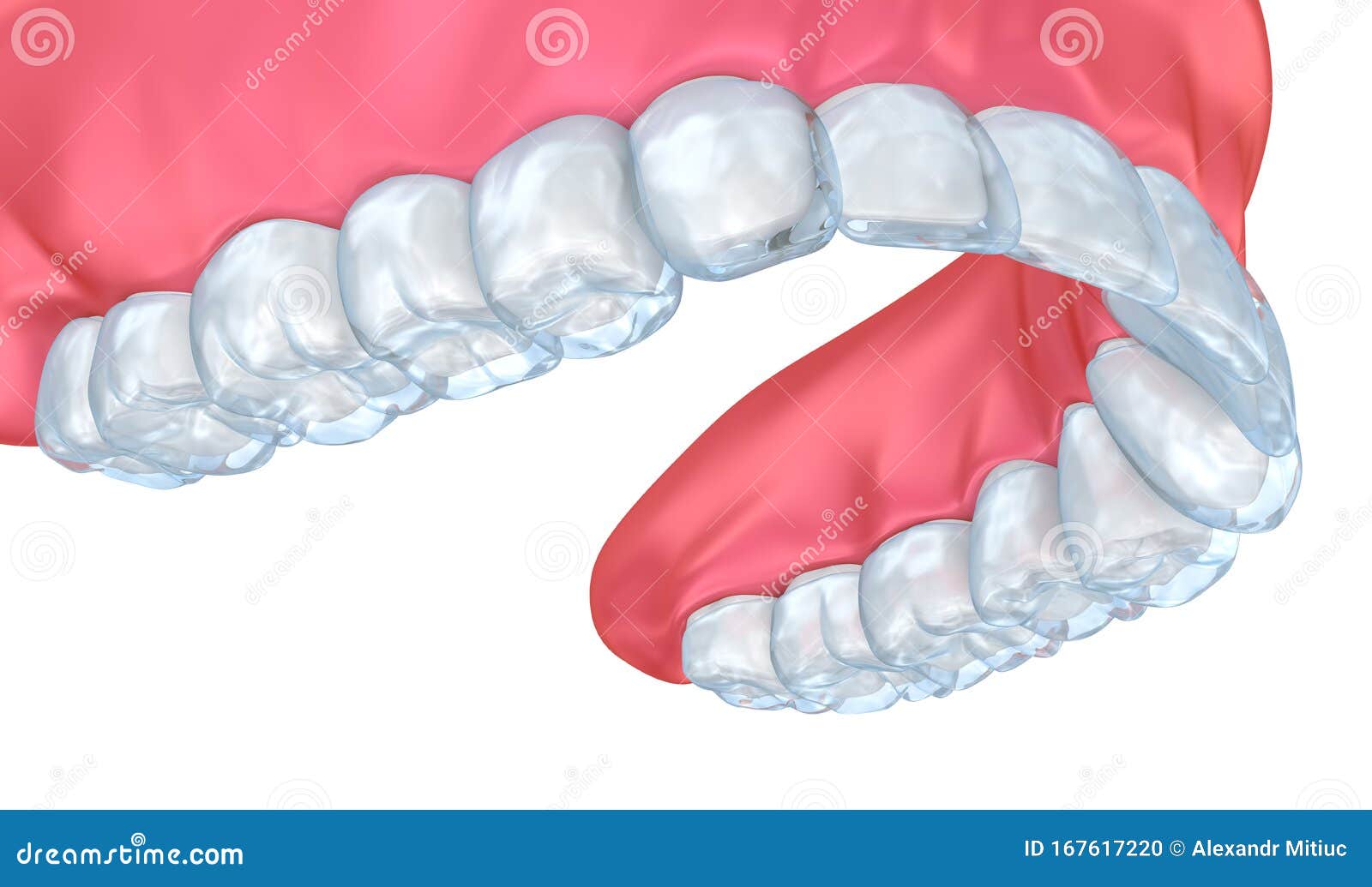 Diagnostic Mockup. Medically Accurate Tooth Stock Illustration ...