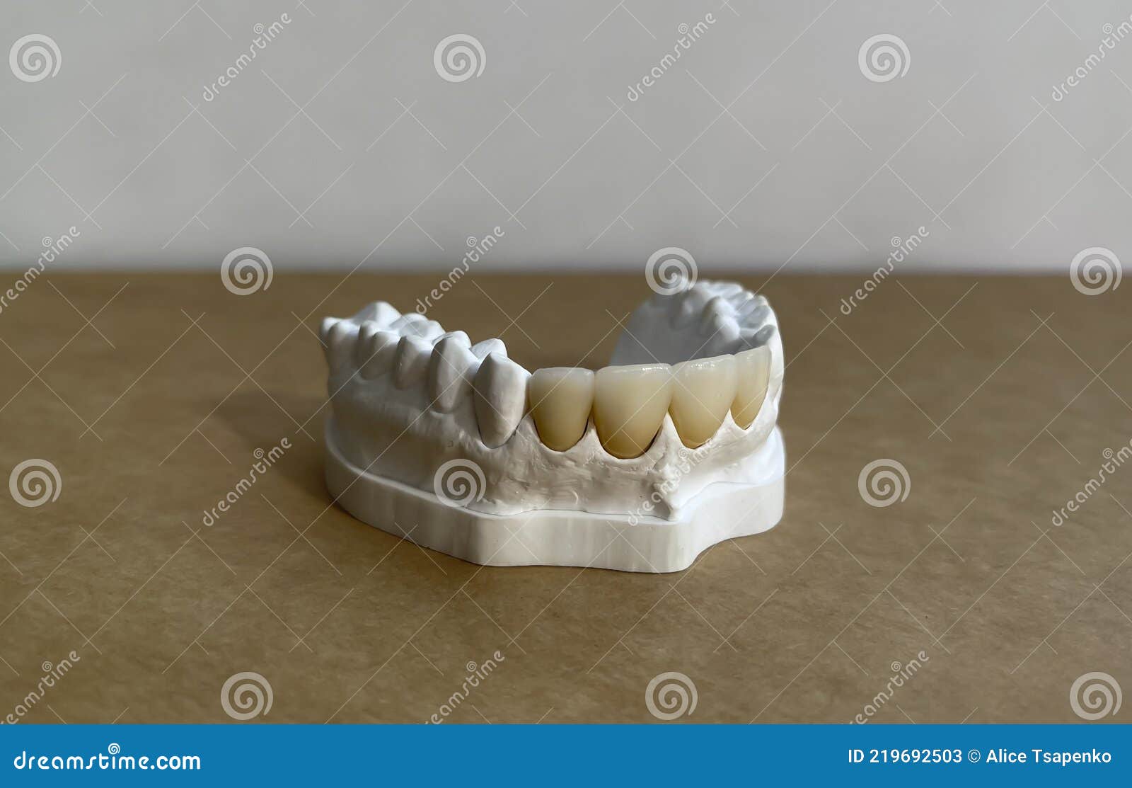 Diagnostic Model with Veneers of the Front Teeth on the Table in the ...