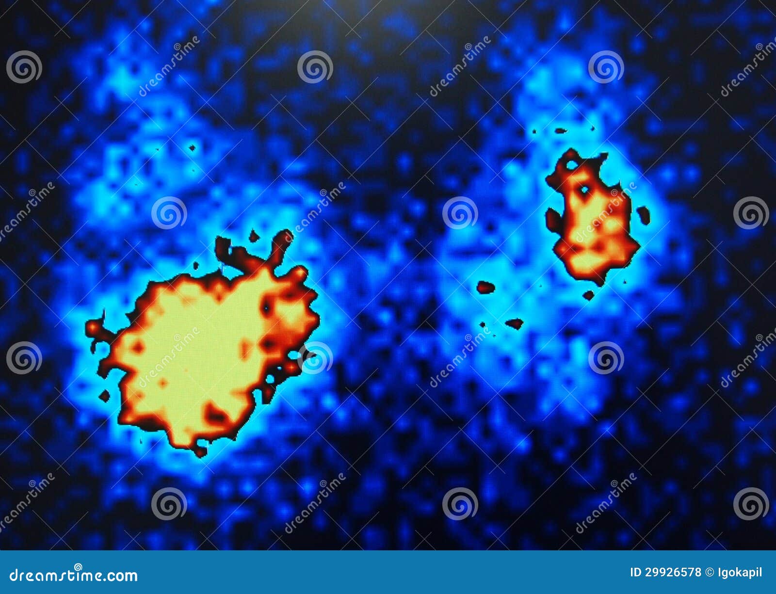 Thyroid Nodule Ultrasound Royalty-Free Stock Photo | CartoonDealer.com ... Thyroid Nodule Ultrasound Royalty-Free Stock Photo | CartoonDealer.com ...