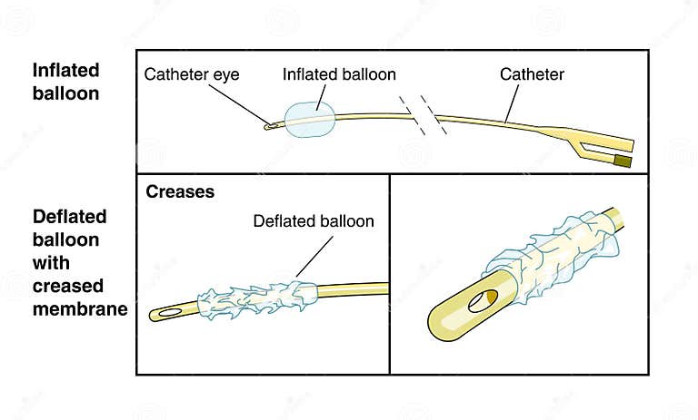 Diagram of a catheter stock illustration. Illustration of catheter ...
