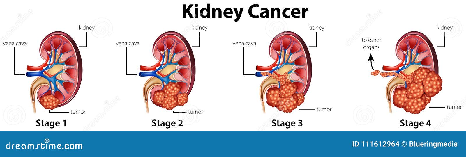 Diagram Showing Different Stages of Kidney Cancer Stock Illustration ... Diagram Showing Different Stages of Kidney Cancer Stock Illustration ...