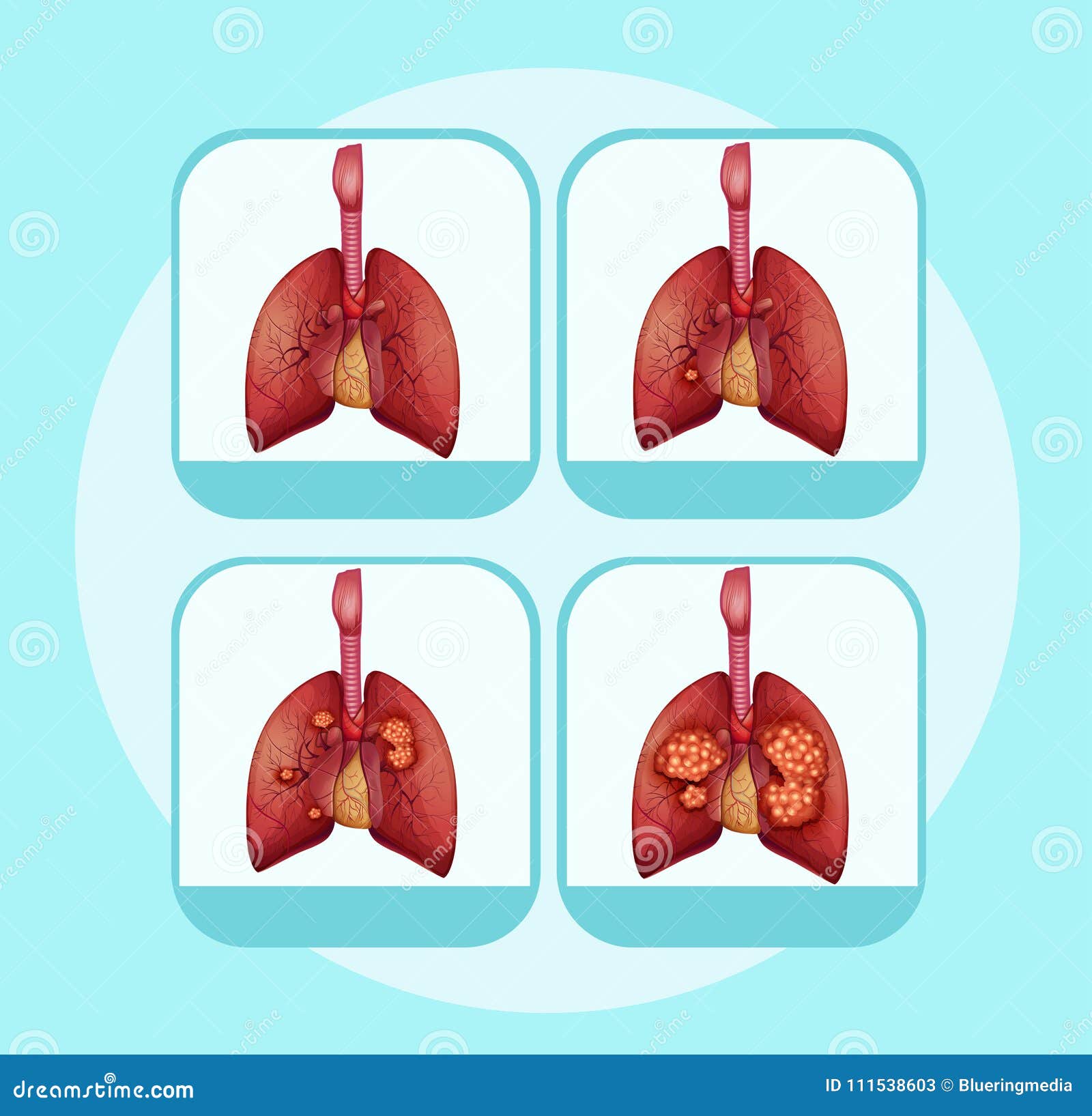 Diagram Showing Different Stages Of Lung Cancer Stock Vector Illustration Of Ackground