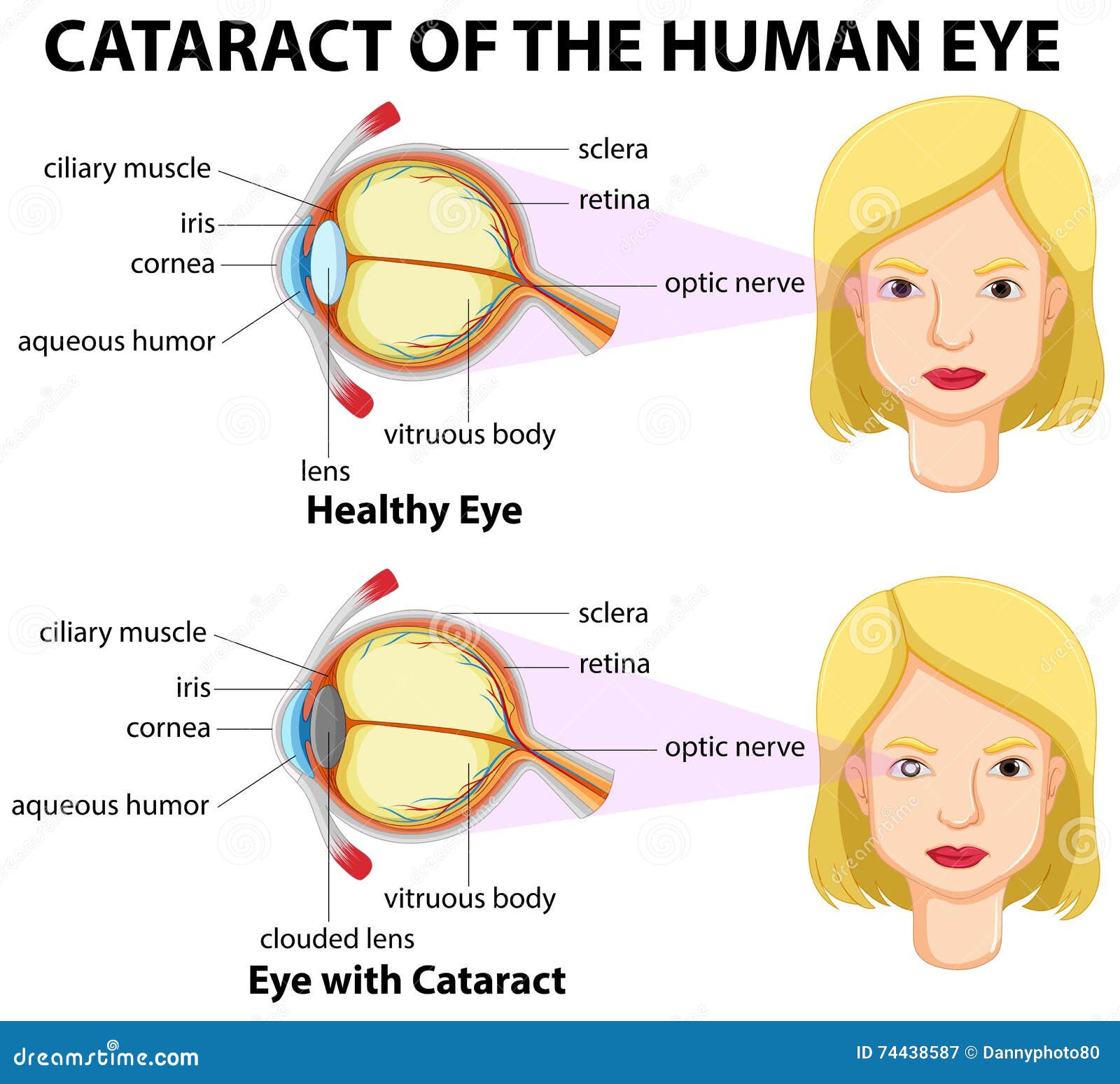 Diagram Showing Eyes with Cataract Stock Vector - Illustration of white ...