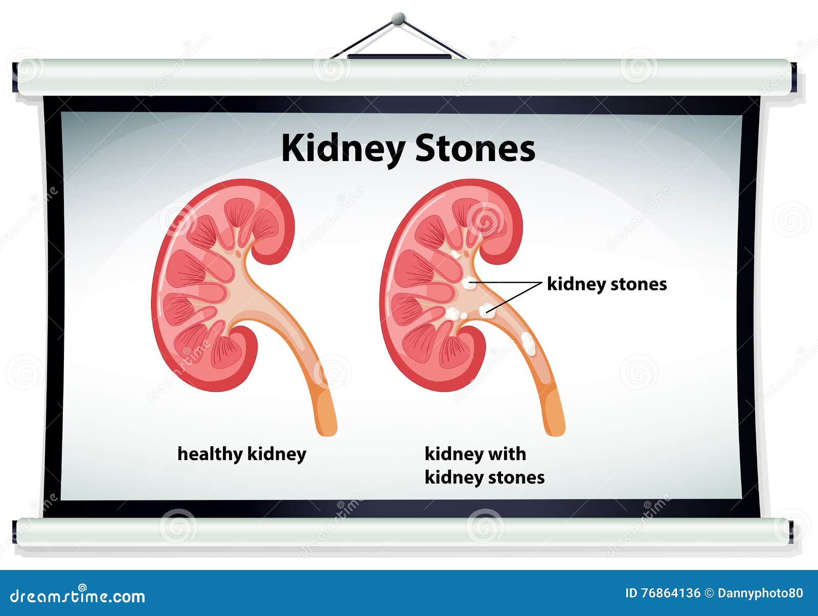 Diagram Showing Kidney Stones Stock Vector - Illustration of kidney ...