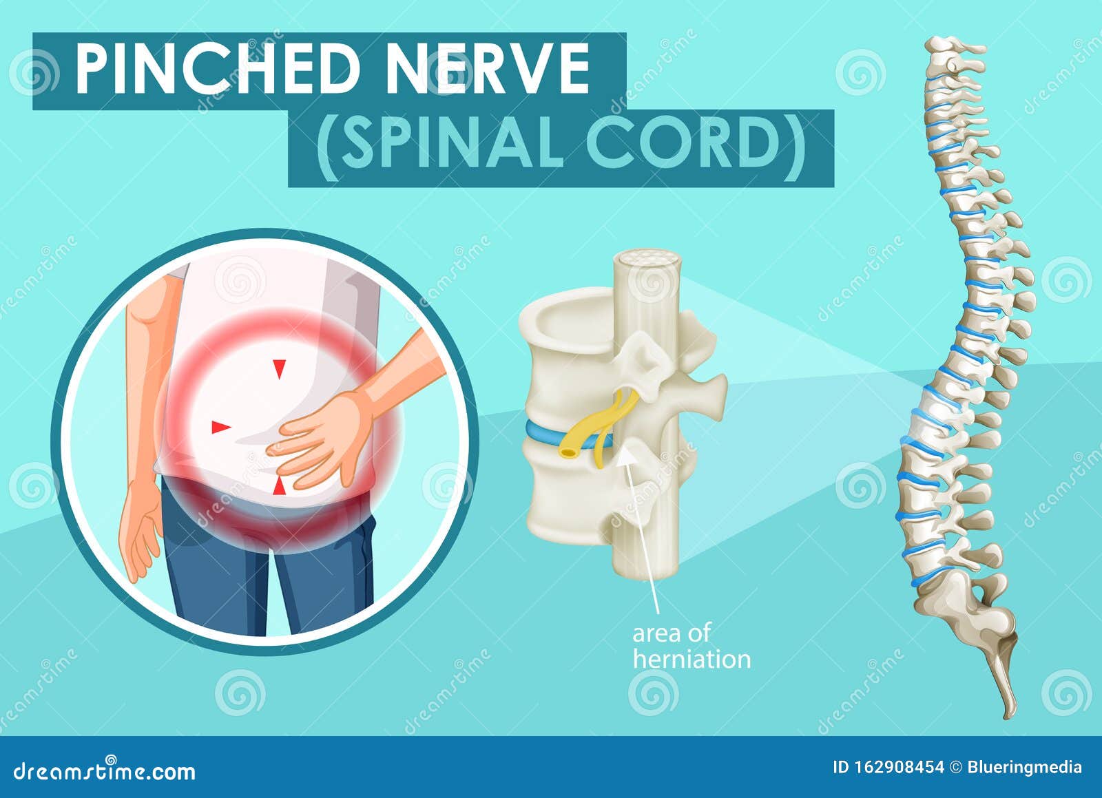 Diagram Showing Pinched Nerve in Human Stock Vector - Illustration of ... Diagram Showing Pinched Nerve in Human Stock Vector - Illustration of ...