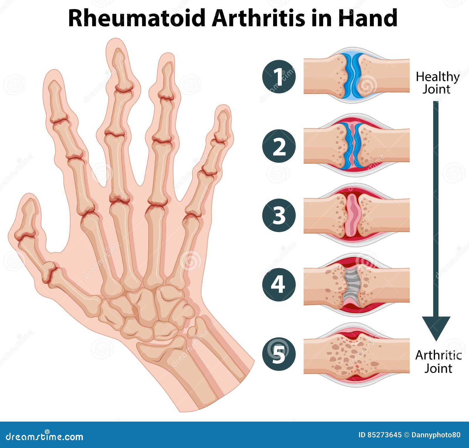 Diagram Showing Rheumatoid Arthriitis in Hand Stock Illustration ...