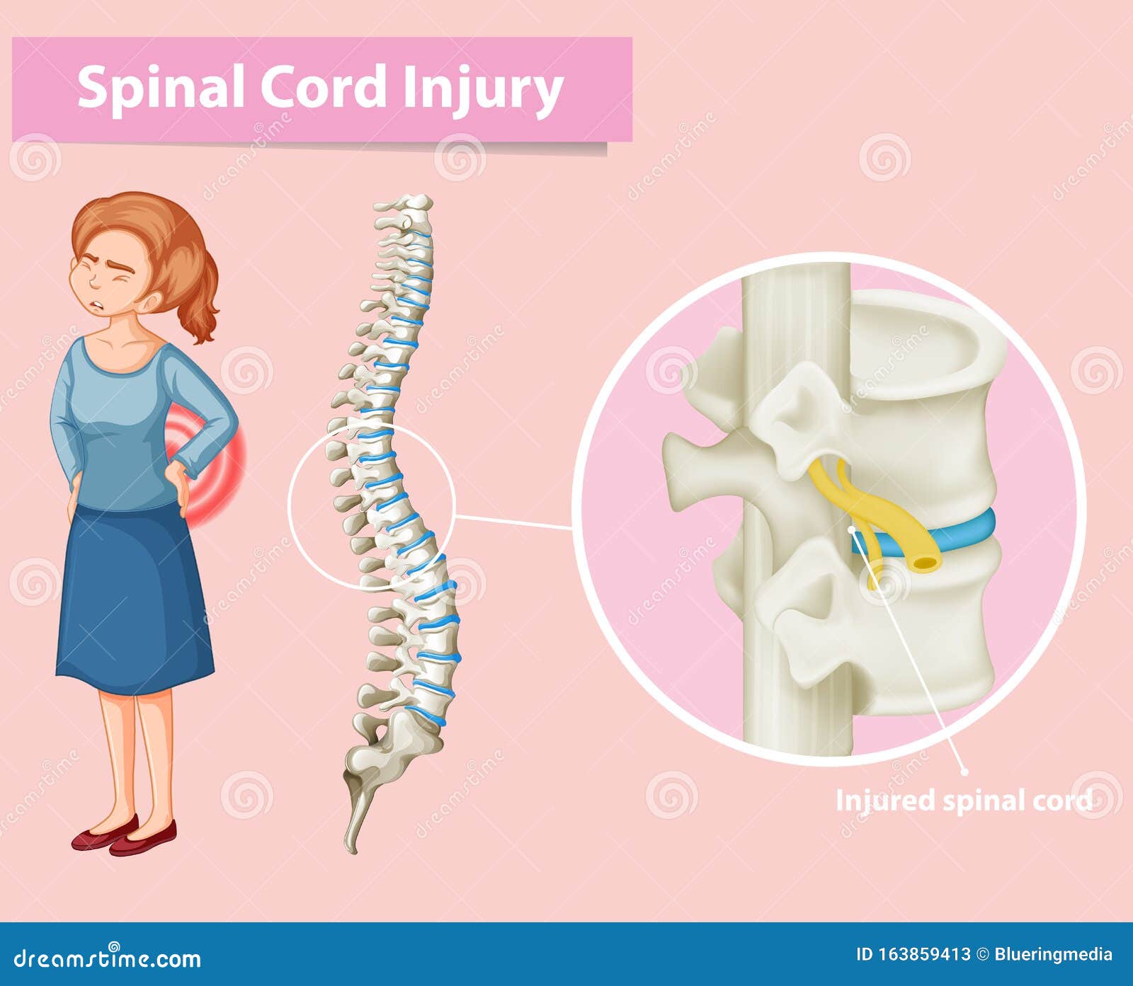 Diagram Showing Spinal Cord Injury in Human Stock Vector - Illustration ... Diagram Showing Spinal Cord Injury in Human Stock Vector - Illustration ...