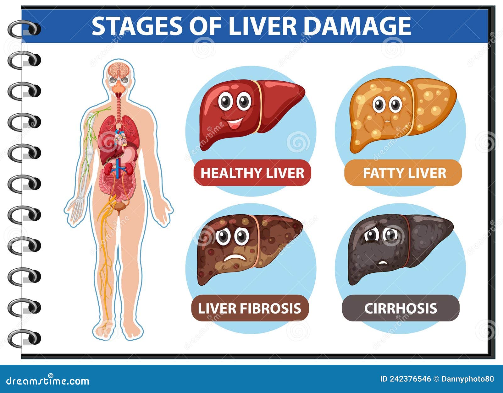 Diagram Showing Stages of Liver Damage Stock Vector - Illustration of ... Diagram Showing Stages of Liver Damage Stock Vector - Illustration of ...