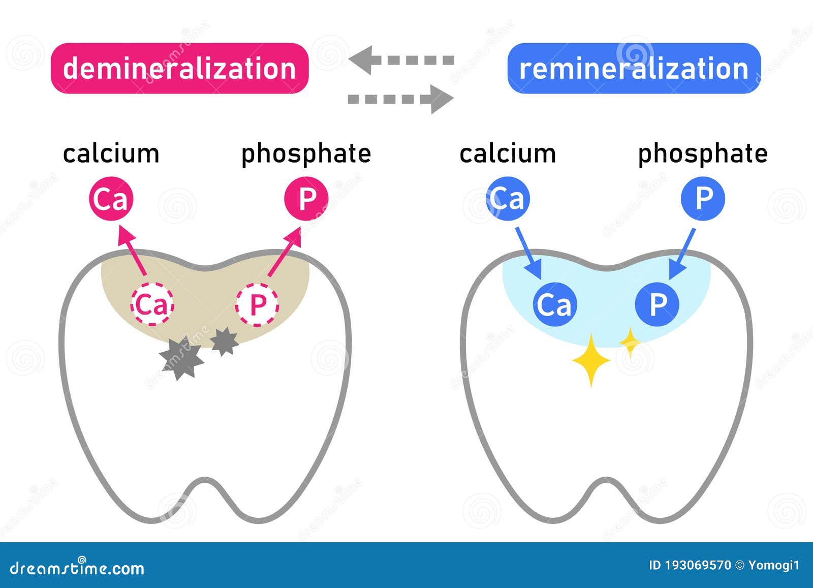 Diagram Of Tooth Demineralization And Remineralization Dental Care