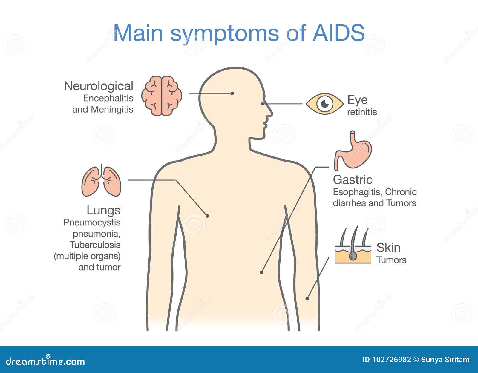 Diagrama De Sintomas Principais Do SIDA Ilustração do Vetor ...