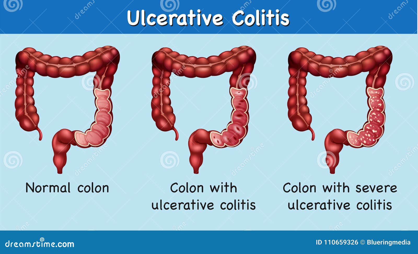 Diagrama Que Mostra a Colite Ulcerosa Ilustração do Vetor - Ilustração ...