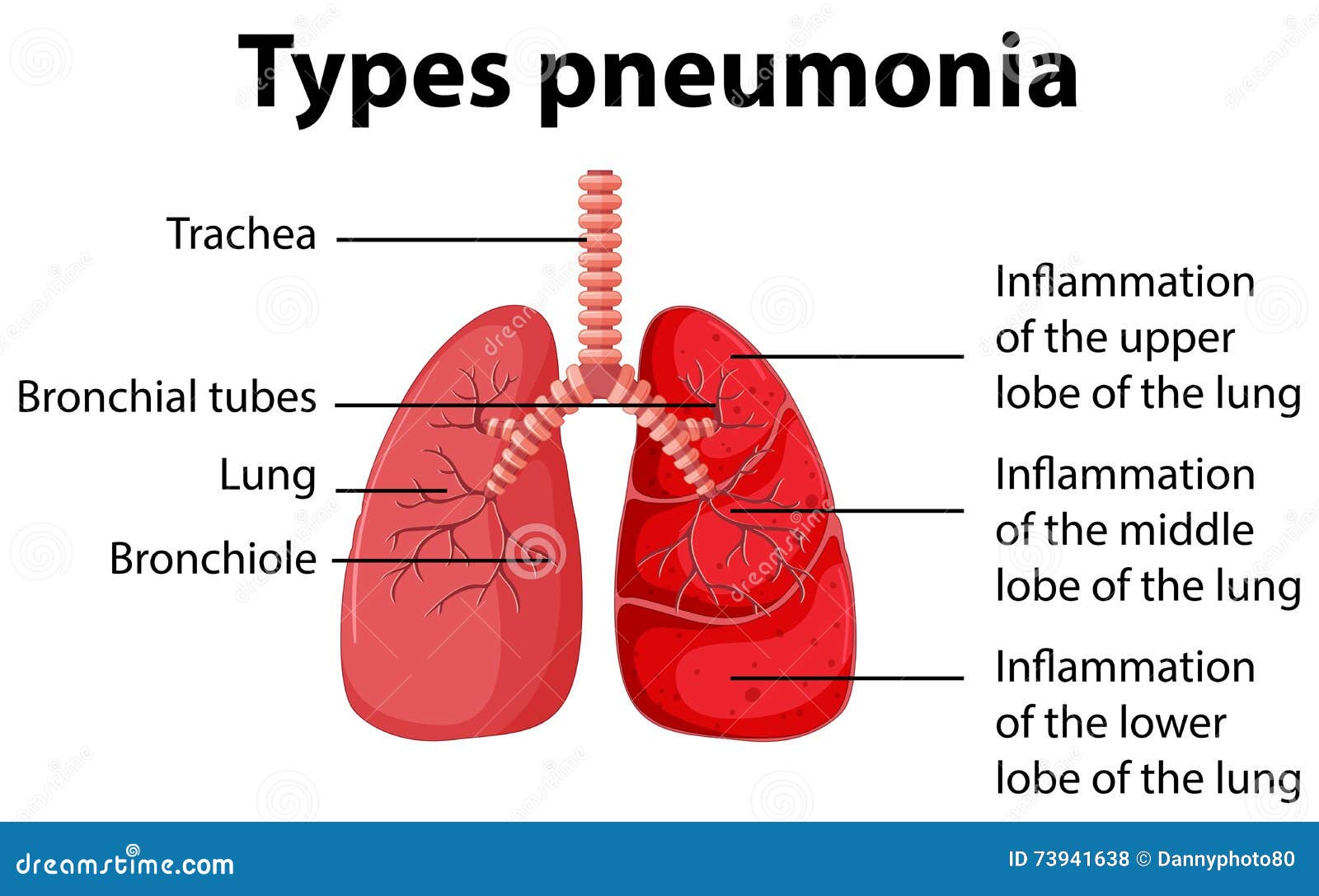 Diagramma Che Mostra I Tipi Polmonite Illustrazione Vettoriale ...