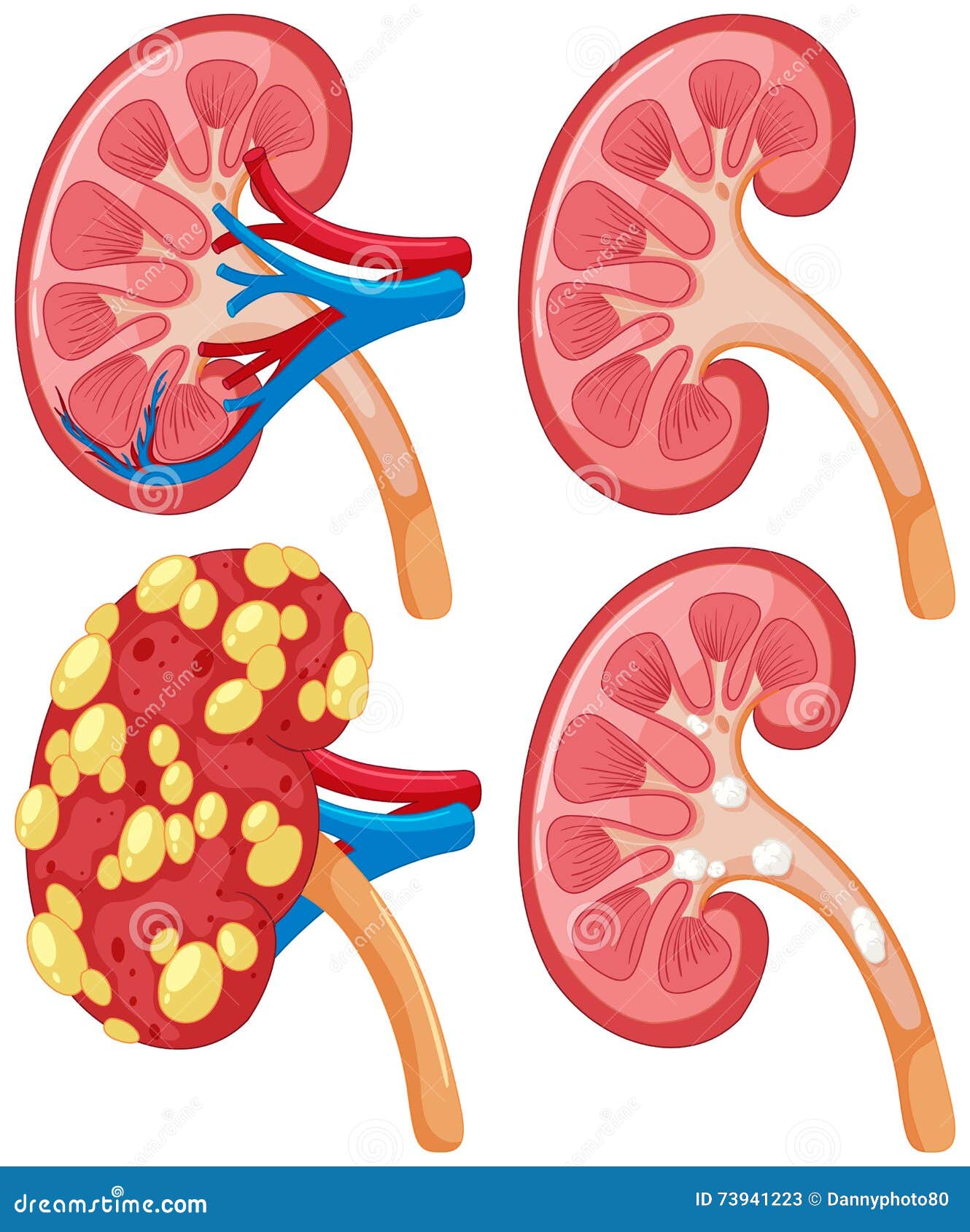 Diagramma Del Rene Con La Malattia Illustrazione Vettoriale ...