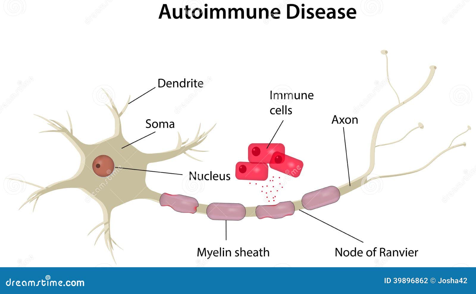 Diagramme De Maladie Auto-immune Illustration de Vecteur - Illustration ...