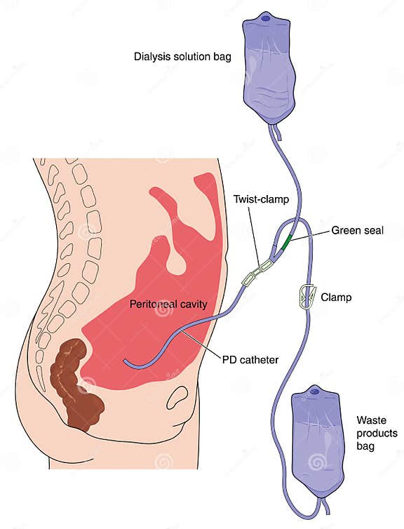 Dialyse Péritonéale Illustration De Vecteur Illustration Du Dépose