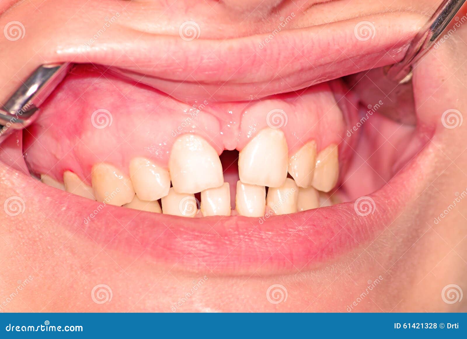 Malocclusion, Overcrowding Of Both Upper And Lower Teeth Royalty-Free ...