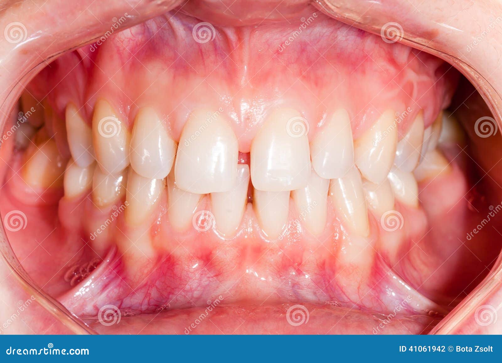 Diasteme stock photo. Image of aesthetic, hygiene, dentist - 41061942