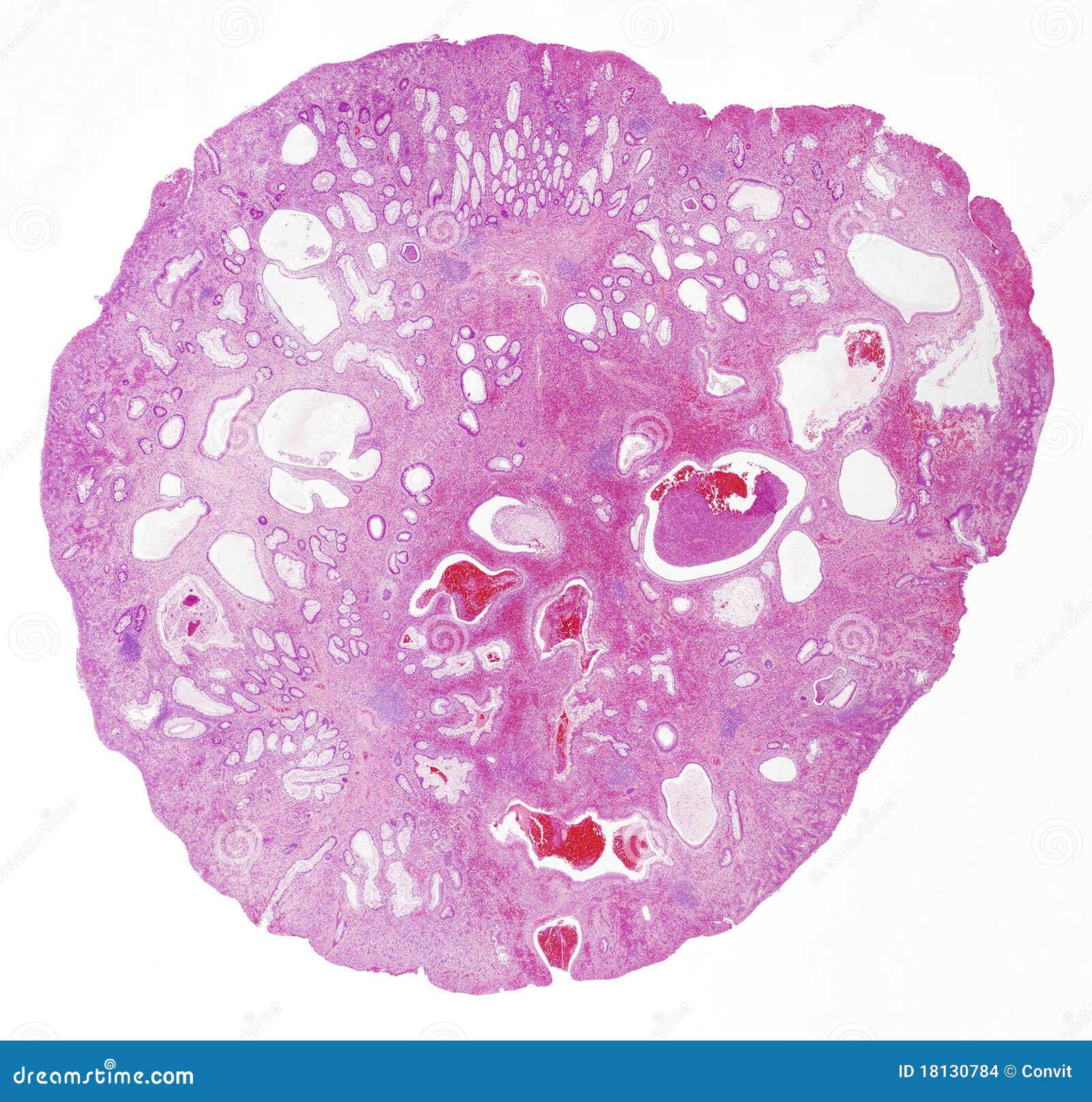 Dickdarmpolyp stockfoto. Bild von wachstum, mikroskopisch - 18130784