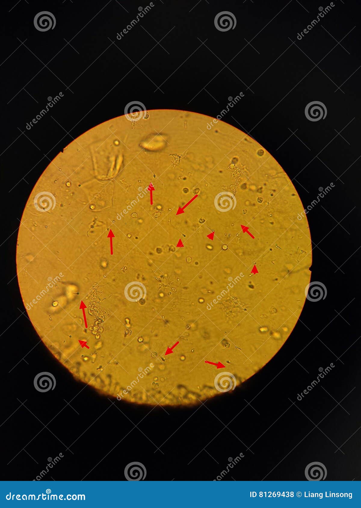 Die Urinprobe Unter Dem Mikroskop Stockfoto - Bild von leukozyte, labor ...