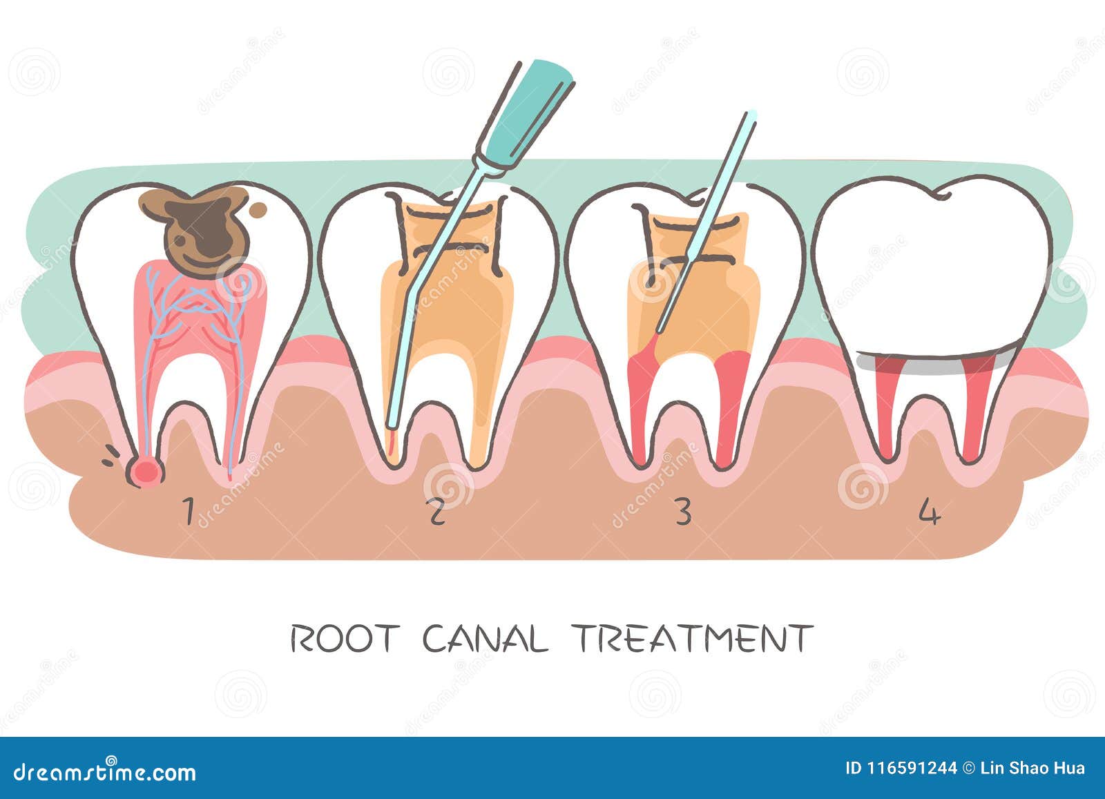 Diente Con El Tratamiento De La Endodoncia Ilustración del Vector ...