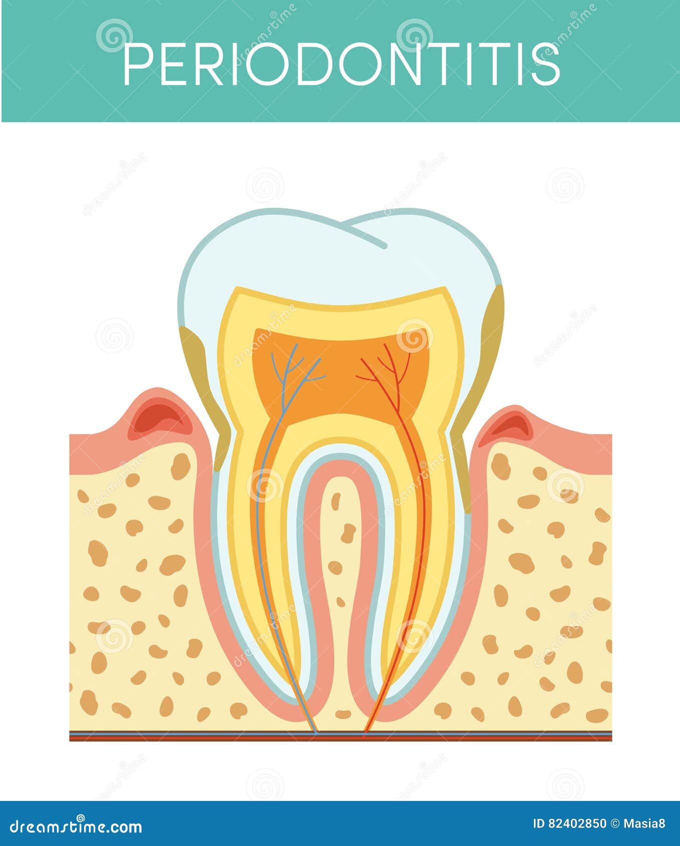 Diente con periodontitis stock de ilustración. Ilustración de goma ...