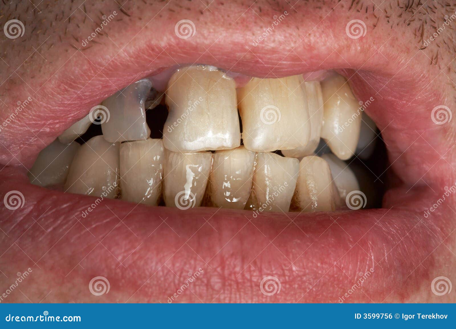 Diente enfermo foto de archivo. Imagen de cruel, oral - 3599756