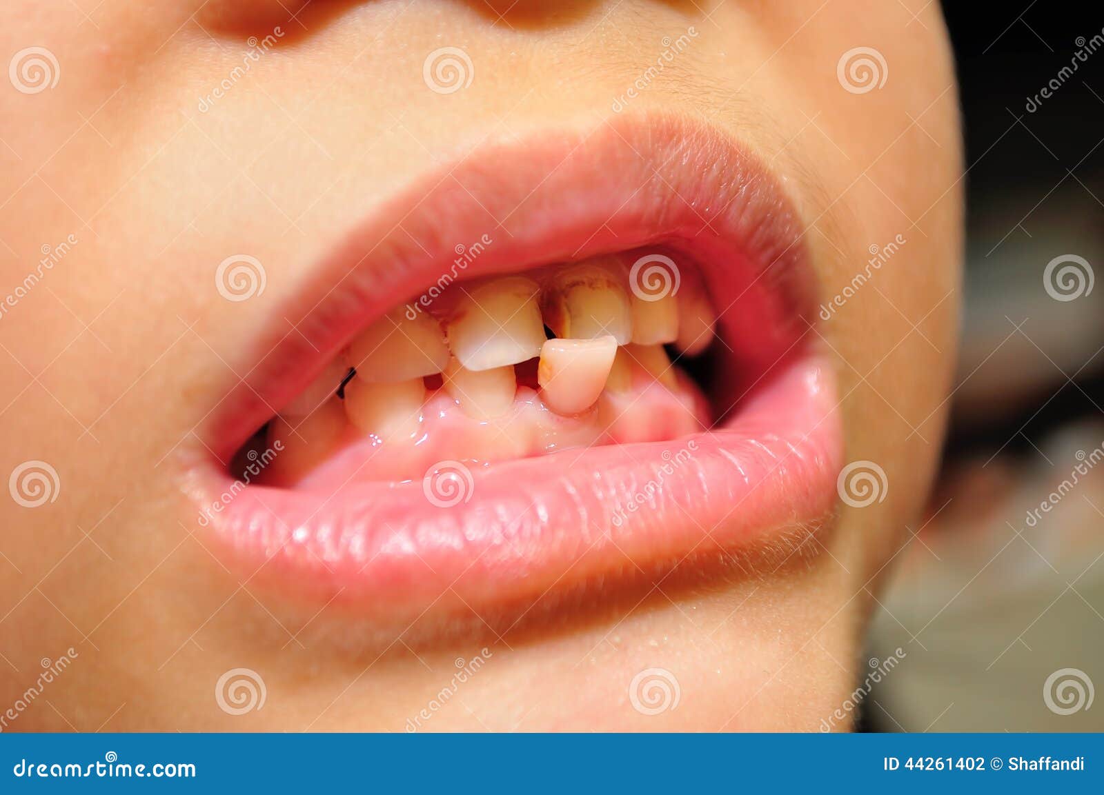 Diente flojo del niño foto de archivo. Imagen de cabrito - 44261402