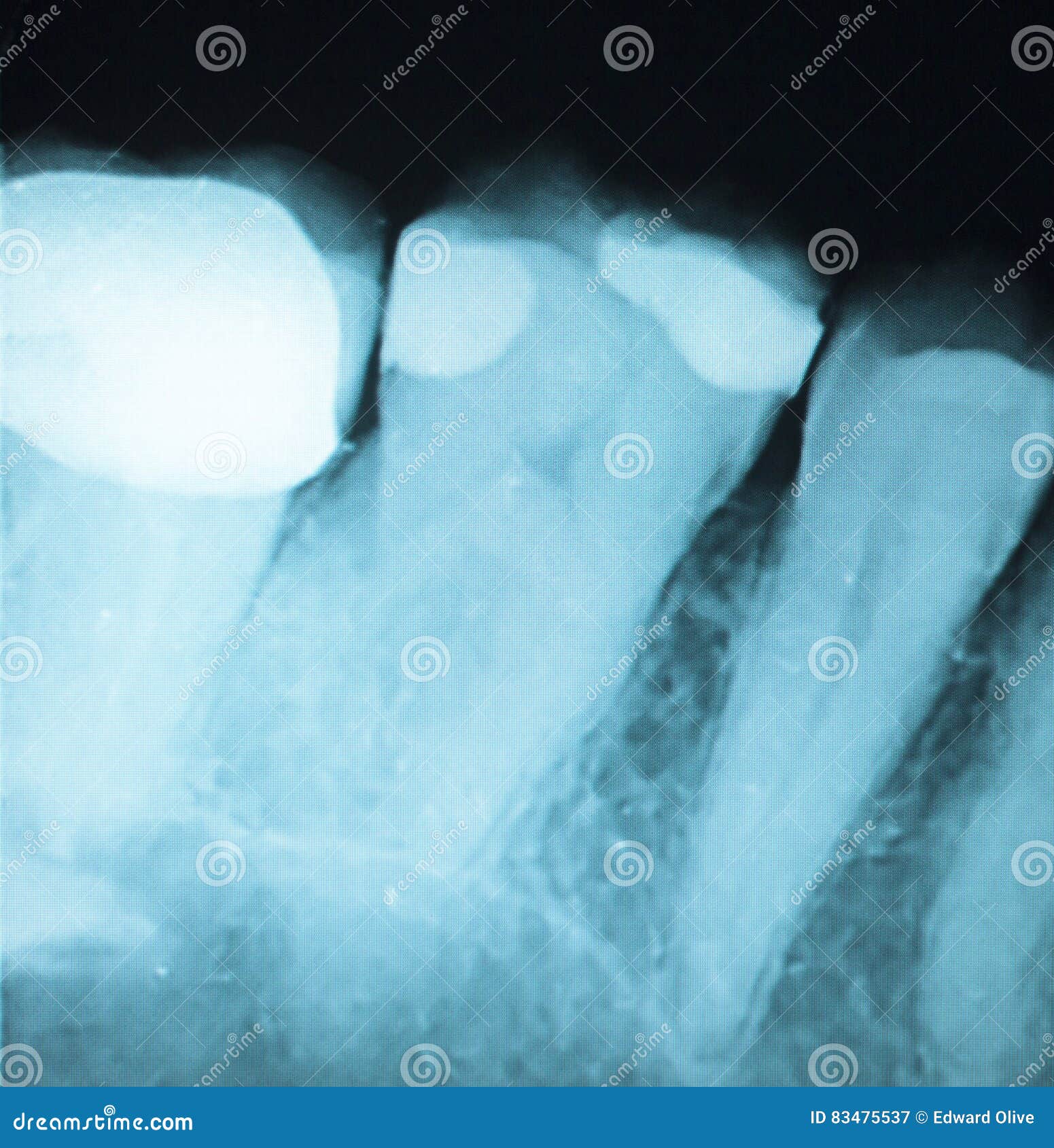Diente Que Llena La Radiografía Dental Imagen de archivo - Imagen de ...