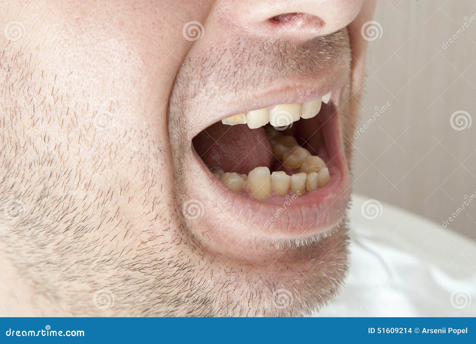 Dientes Enfermos Del Paciente Foto de archivo - Imagen de incisivo ...