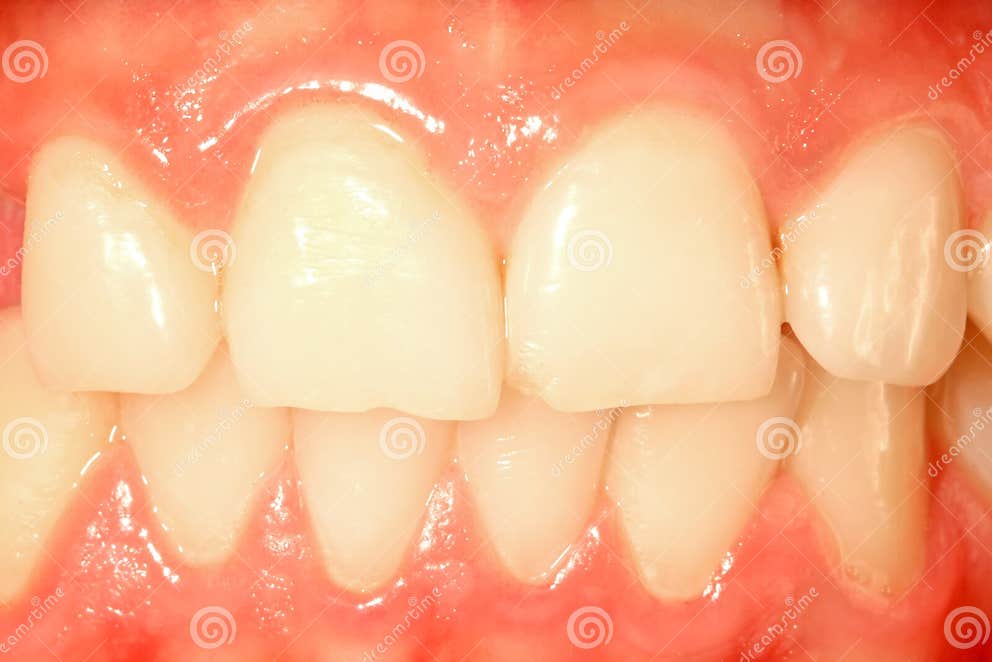 Dientes frontales imagen de archivo. Imagen de muela - 28494585