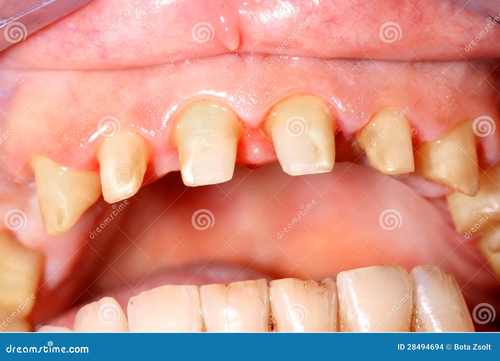 Dientes frontales foto de archivo. Imagen de medicina - 28494694