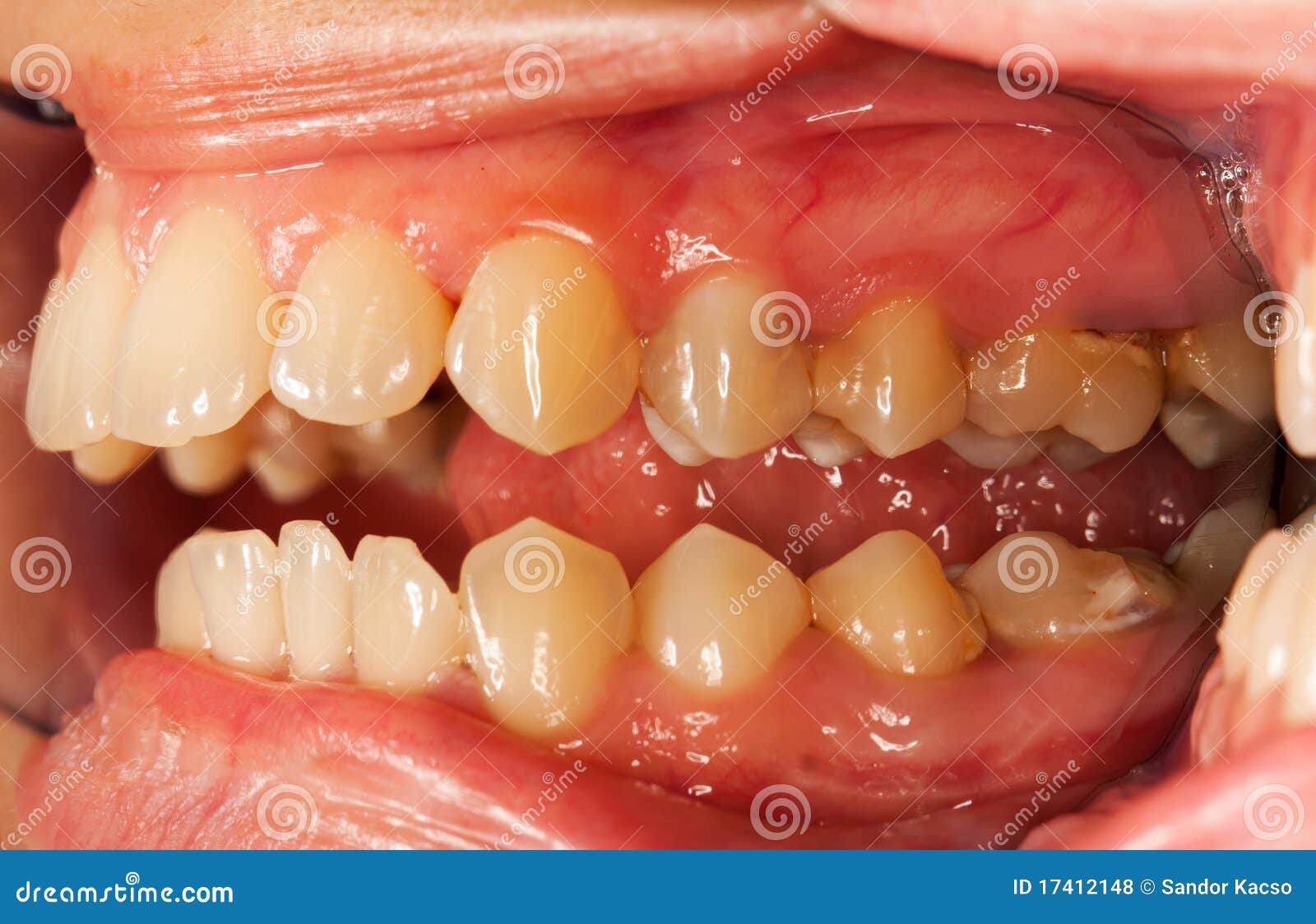 Dientes humanos foto de archivo. Imagen de gomas, decaimiento - 17412148