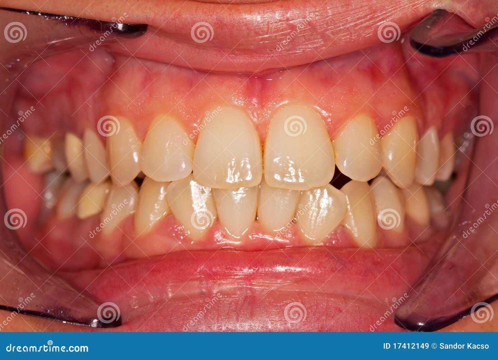 Dientes humanos imagen de archivo. Imagen de salud, boca - 17412149