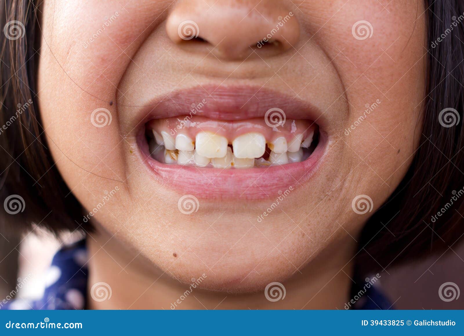 Dientes malsanos imagen de archivo. Imagen de médico - 39433825