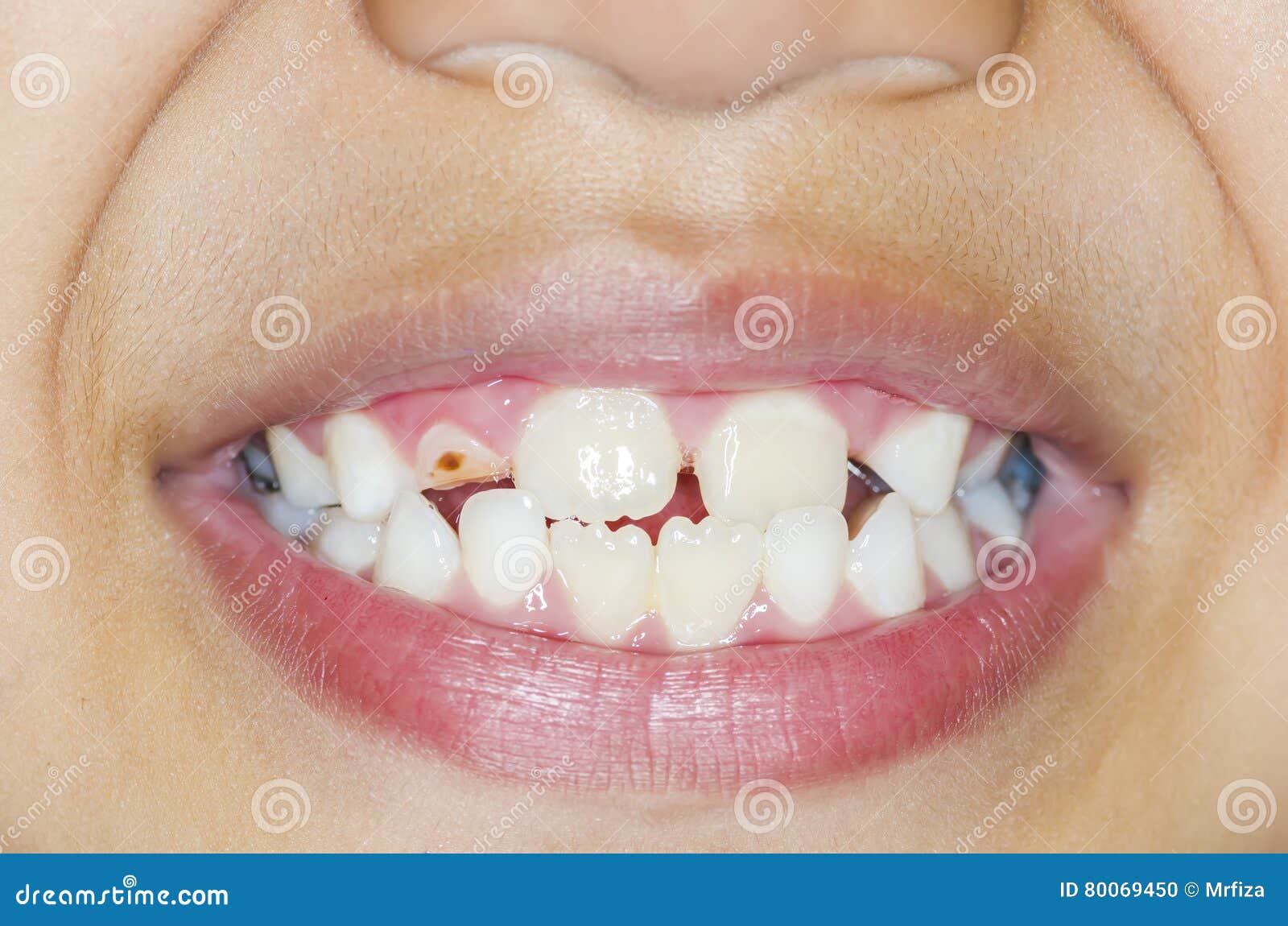 Dientes quebrados foto de archivo. Imagen de decaimiento - 80069450