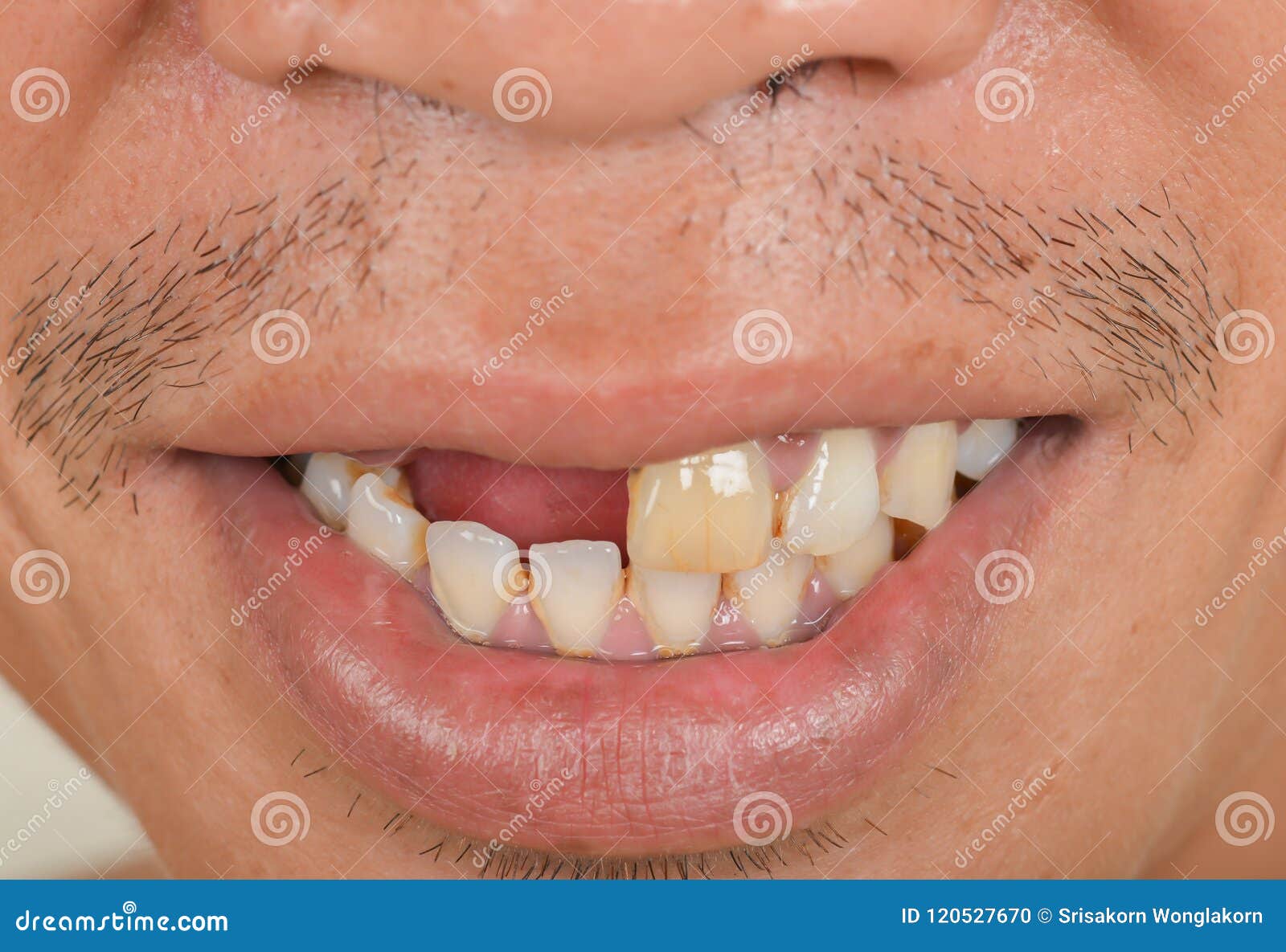 Dientes Quebrados Perjudiciales Y Feos Foto de archivo - Imagen de ...