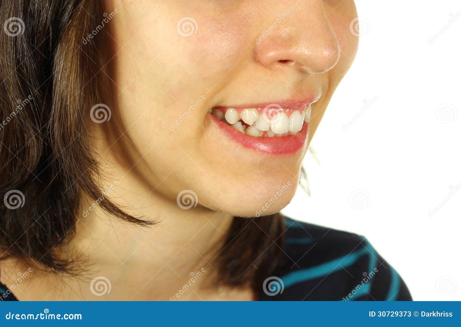 Dientes torcidos imagen de archivo. Imagen de tratamiento - 30729373