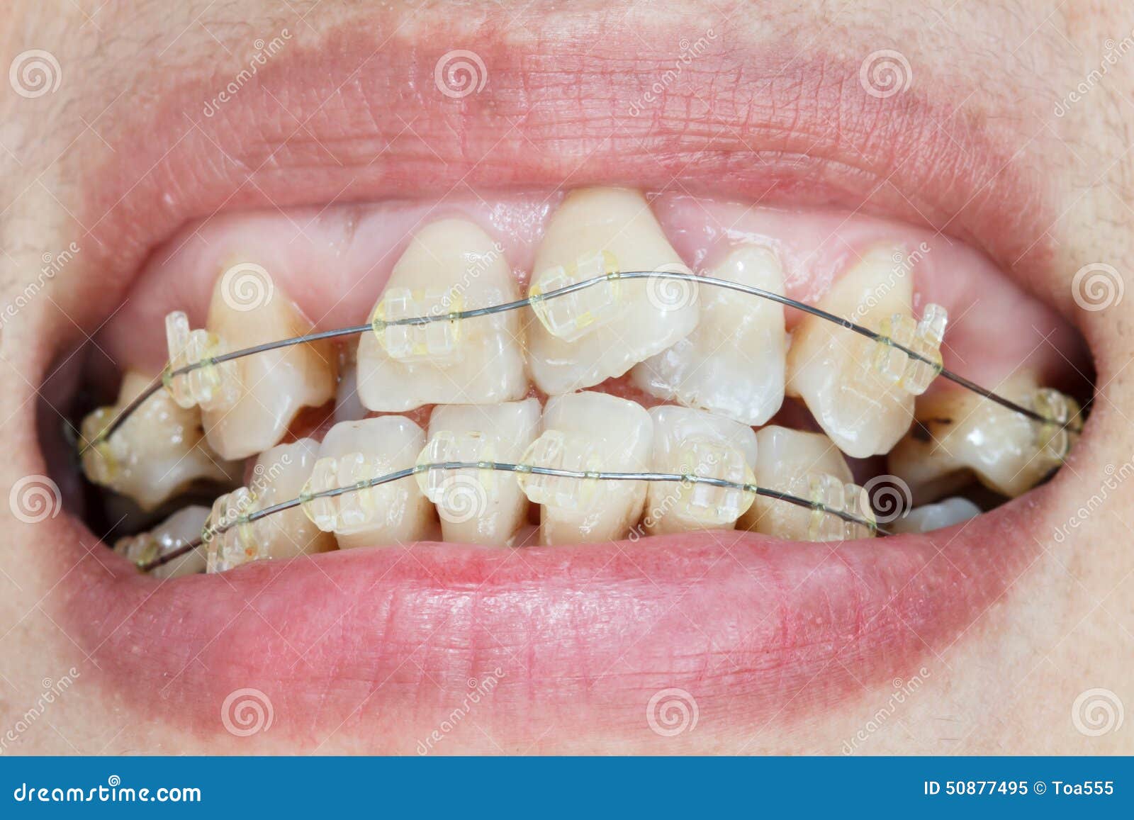 Dientes Torcidos Con Los Apoyos Imagen de archivo - Imagen de ocasional ...