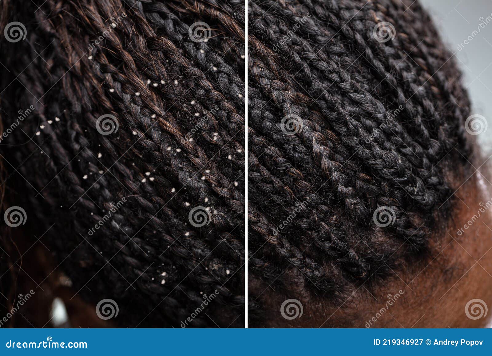 Diferencia De Caspa Y Cabello Limpio Imagen de archivo - Imagen de ...